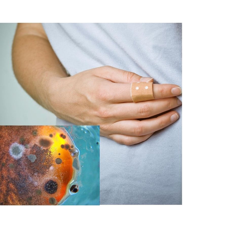 Mold Infection from Surgery - CMG Law